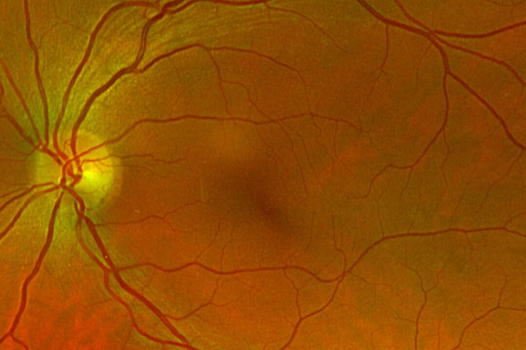 Die trockene altersbedingte Makuladegeneration (AMD) und Therapien ...