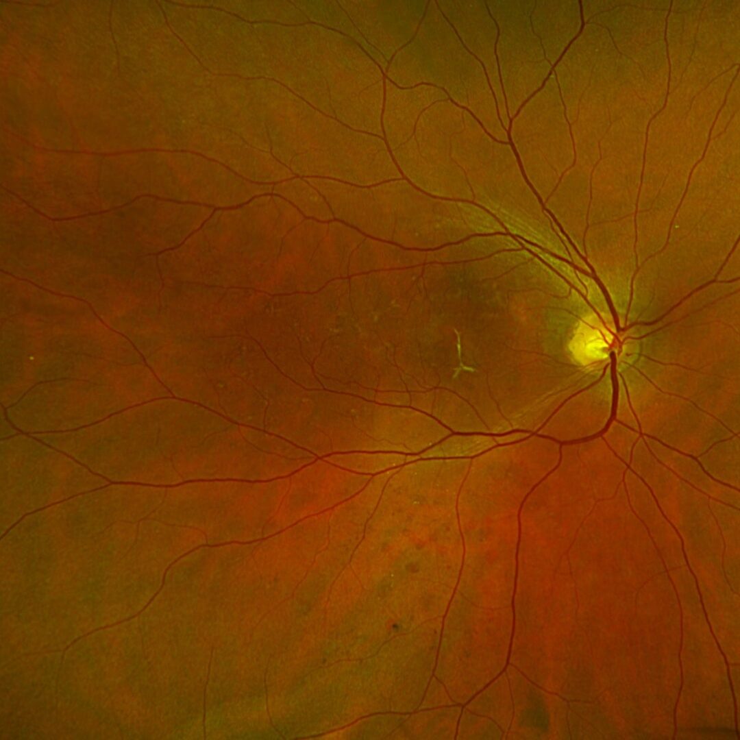 Chorioretinopathia Centralis Serosa (CCS) | Makula-Netzhaut-Myopie ...