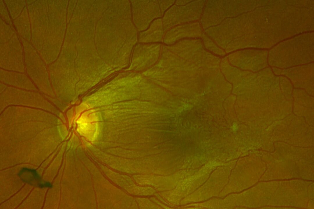 Was ist Macular Pucker oder eine epiretinale Gliose? | Makula-Netzhaut ...