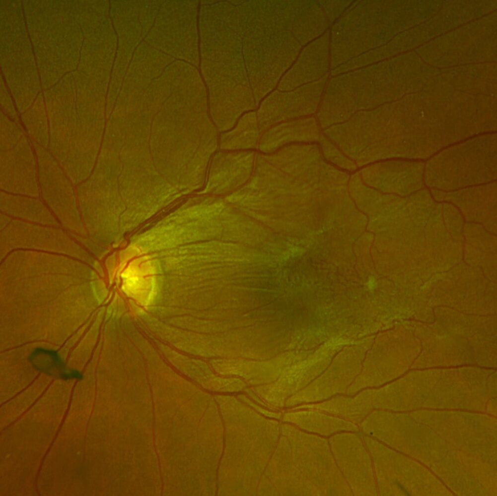 Was ist Macular Pucker oder eine epiretinale Gliose? | Makula-Netzhaut ...