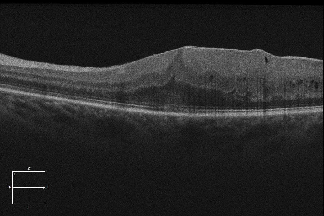 Was ist Macular Pucker oder eine epiretinale Gliose? | Makula-Netzhaut ...