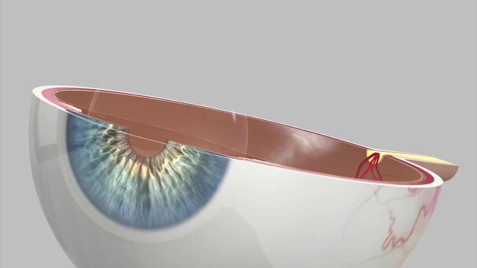 Was ist Macular Pucker oder eine epiretinale Gliose? | Makula-Netzhaut ...