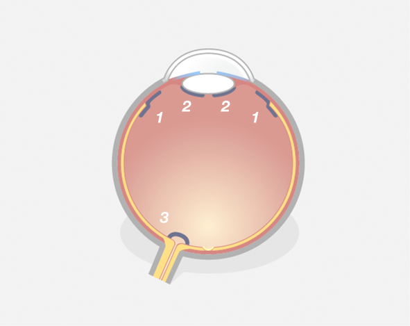 Was ist ein Vitreomakuläres Traktionssyndrom (VMTS)? | Makula-Netzhaut ...