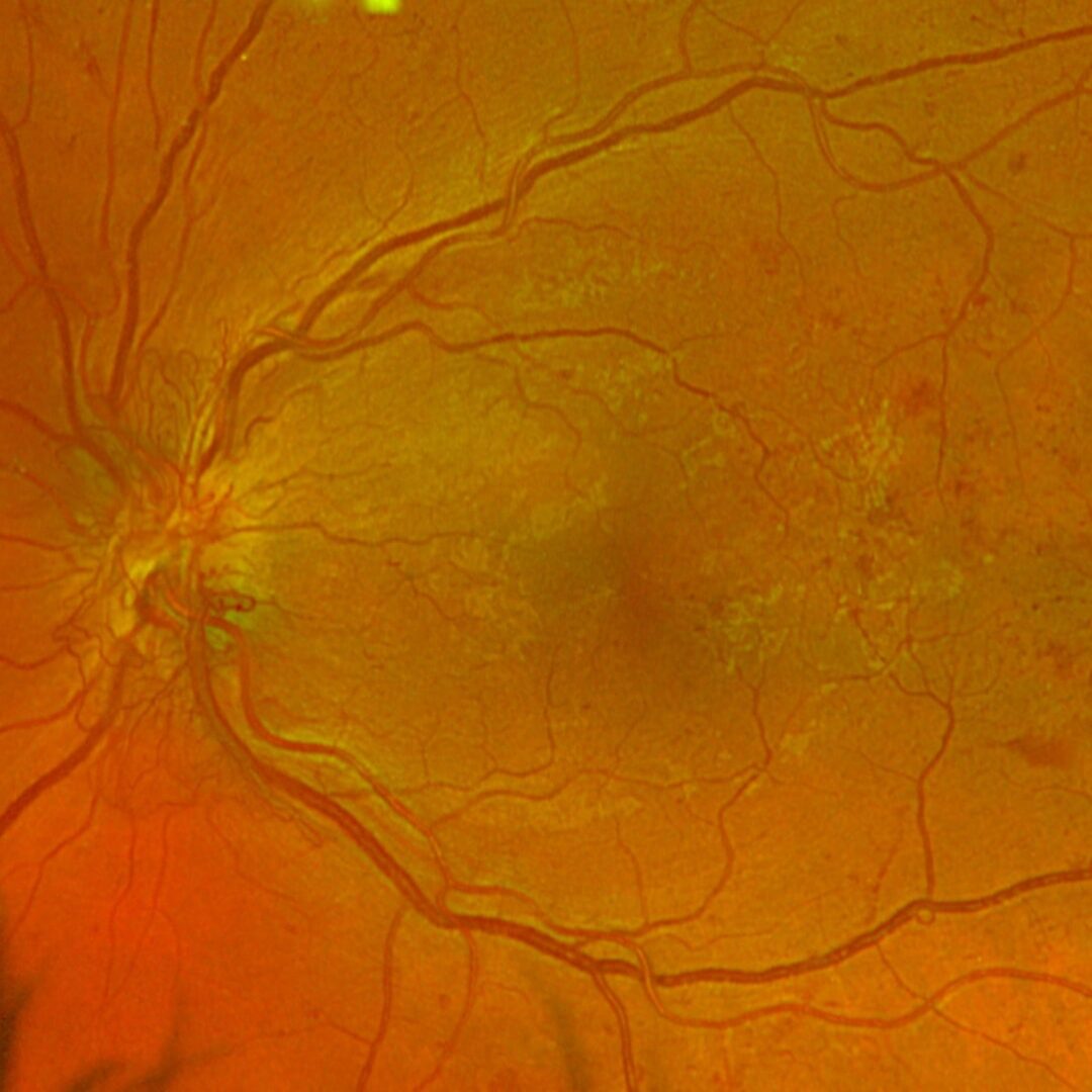 Die diabetische Retinopathie, eine Netzhauterkrankung bei Diabetes ...