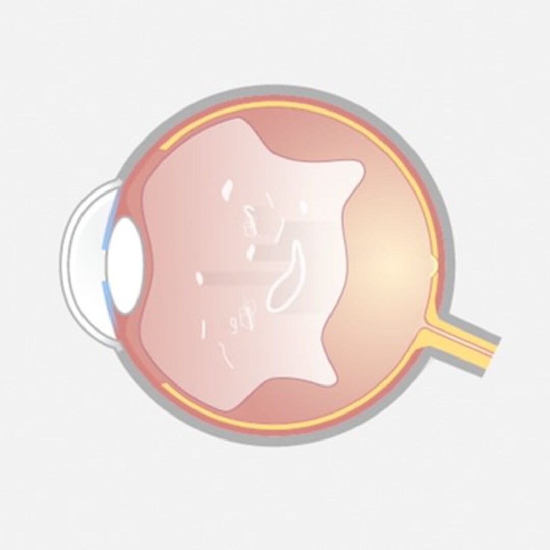 Was sind Glaskörpertrübungen oder Mouches Volantes?