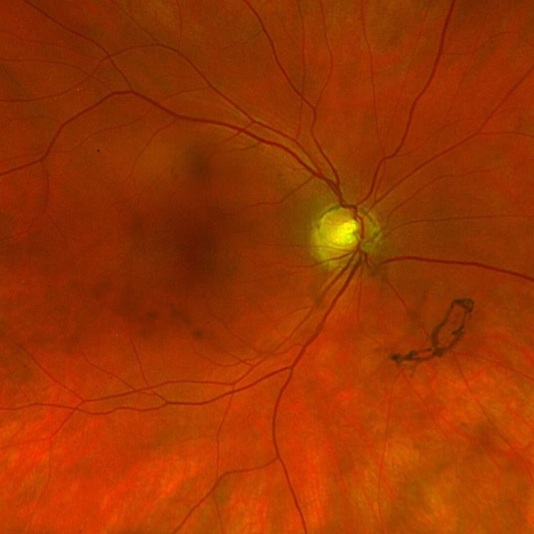 Was sind Glaskörpertrübungen oder Mouches Volantes?