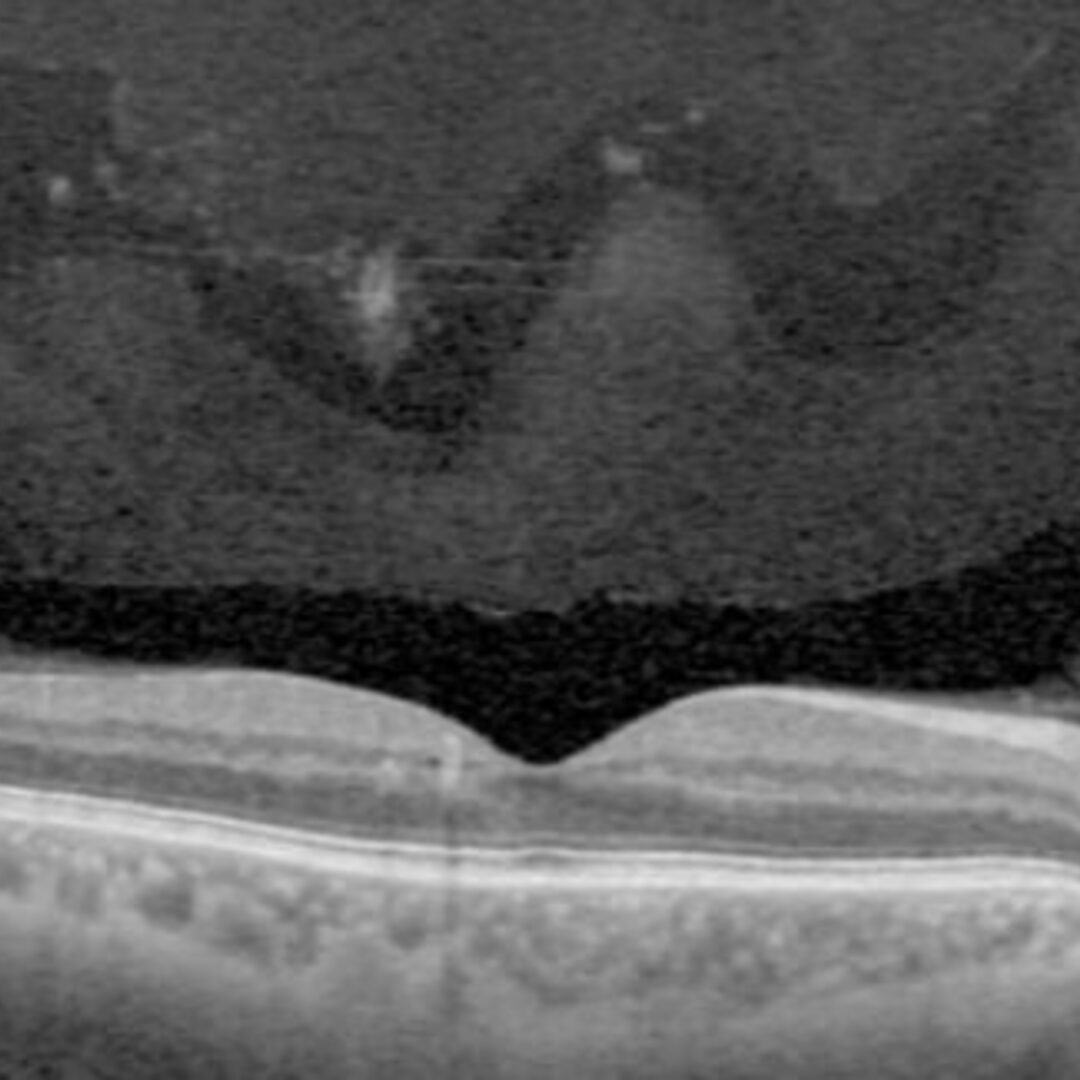 Was sind Glaskörpertrübungen oder Mouches volantes? | Makula-Netzhaut ...
