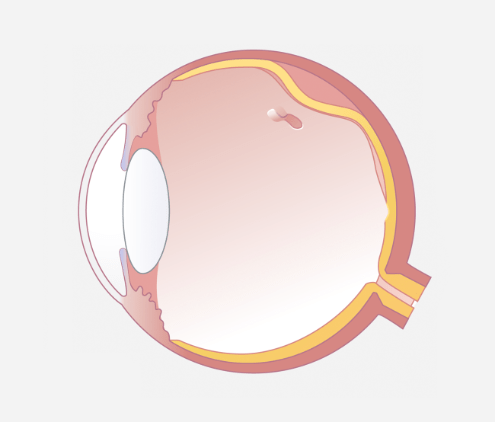 Wie entsteht ein Netzhautloch? | Makula-Netzhaut-Myopie-Zentrum Düsseldorf